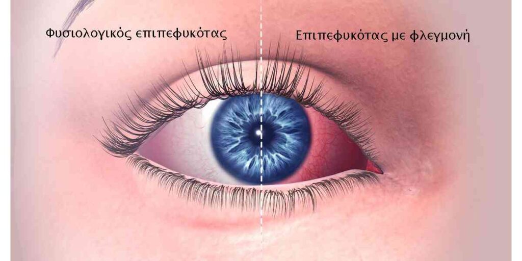 Επιπεφυκίτιδα - Therapia