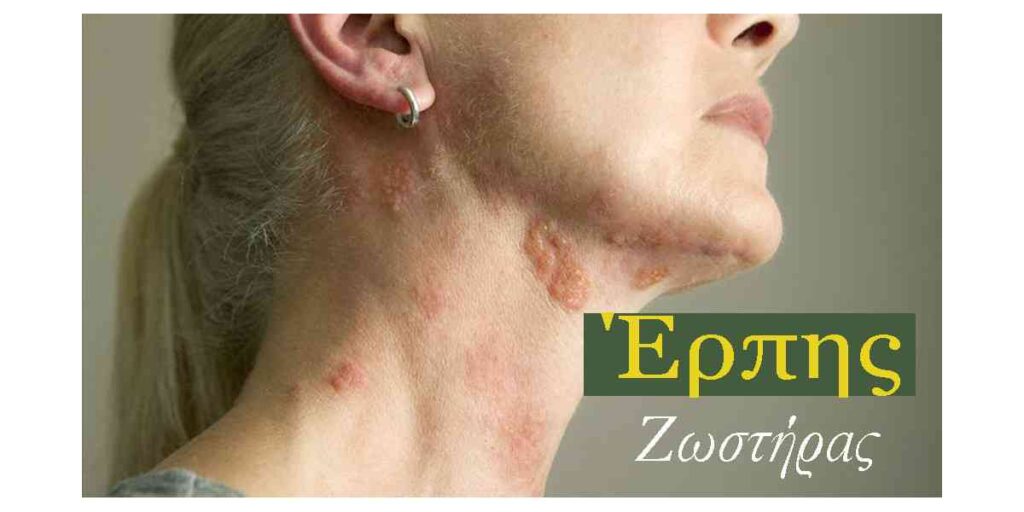 Έρπης ζωστήρας - Αριστοτέλης Βάθης MD MSc ECP | Ψυχίατρος • Ψυχοθεραπευτής