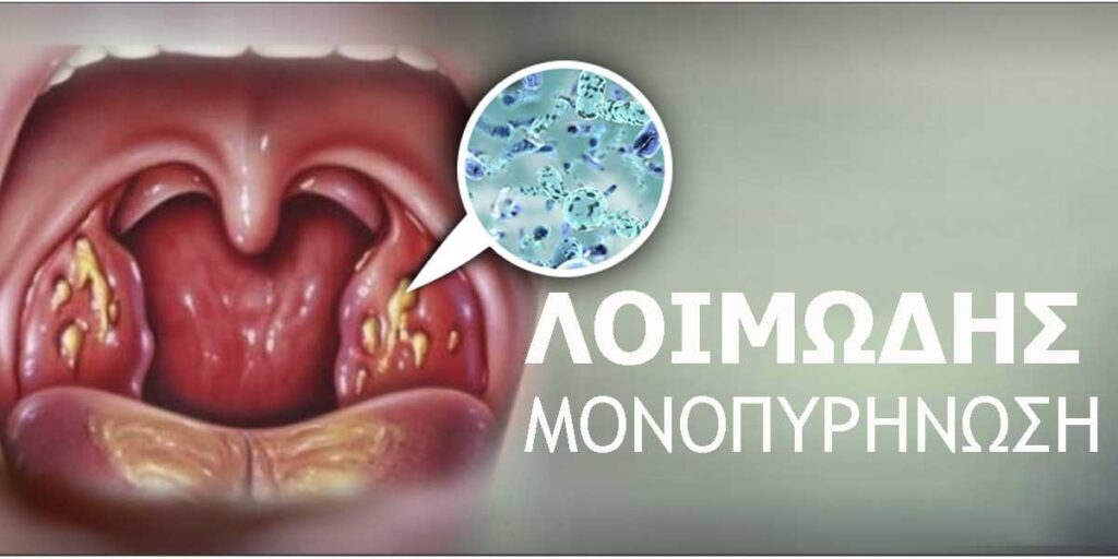 Λοιμώδης μονοπυρήνωση - Αριστοτέλης Βάθης MD MSc ECP | Ψυχίατρος • Ψυχοθεραπευτής